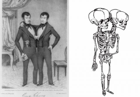Conjoined Twins | Occurance and Survival Rates | Multiple Birth