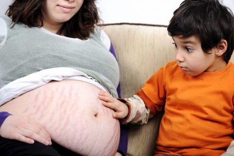 Stretch marks with twin or triplet pregnancy | Multiple Births | Twinfo