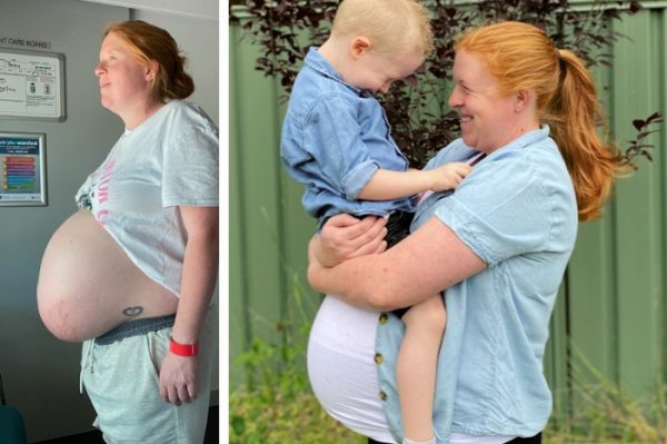 PUPPP and twin pregnancy | My experience with PUPPP | Twinfo