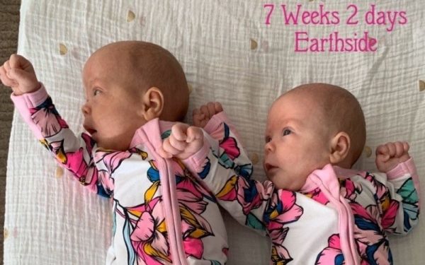 MCMA Twins | Monochorionic Monoamniotic Twin Pregnancy & Birth Story