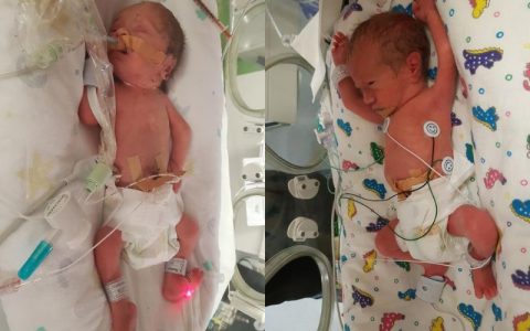 Triplets (With Surviving Fraternal Boy Twins) Born at 29+4